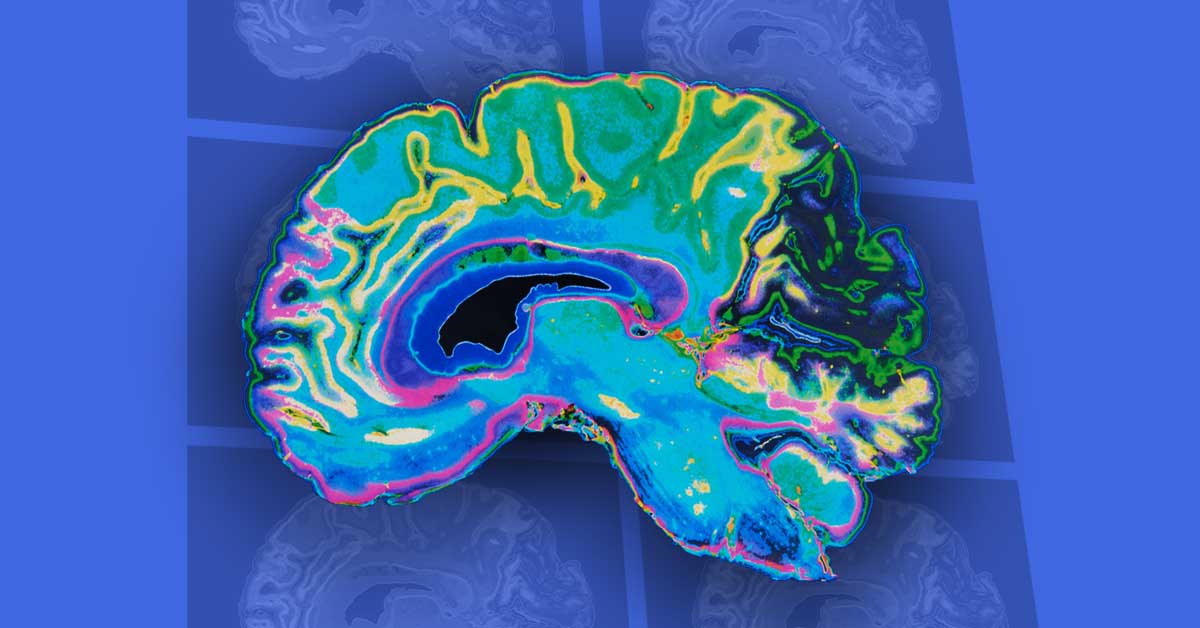 Using plasma proteomics to understand Alzheimer's and other brain ...